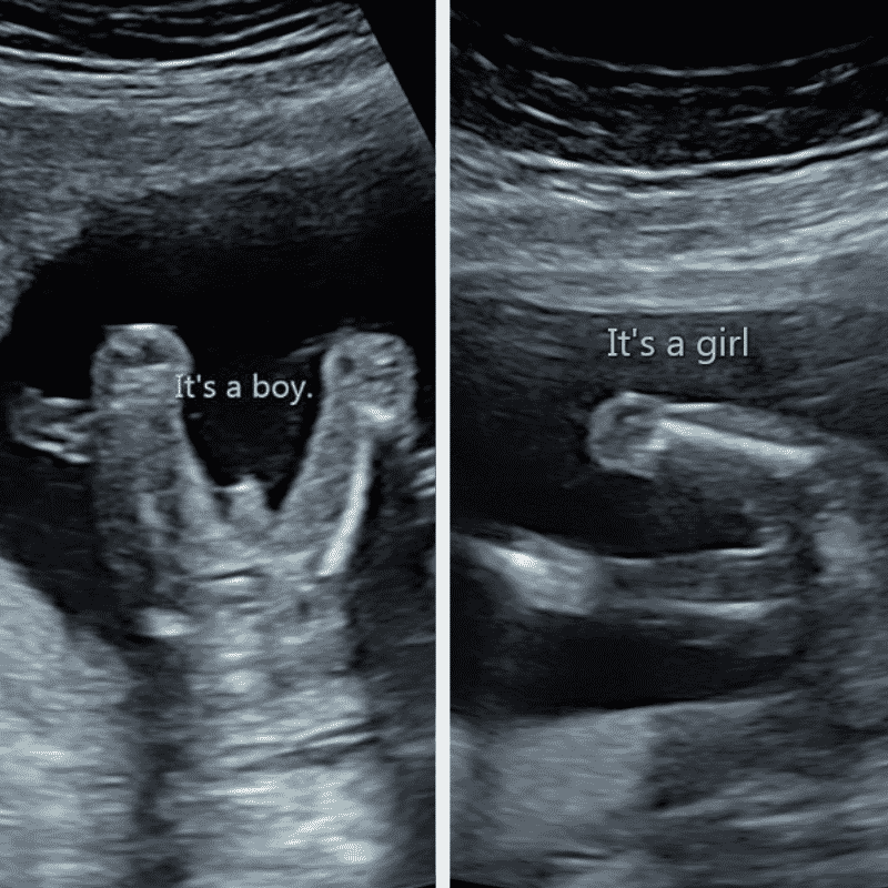 sonogram at 14 weeks